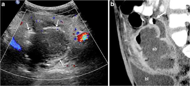 Ultrasound of the pediatric appendix | SpringerLink