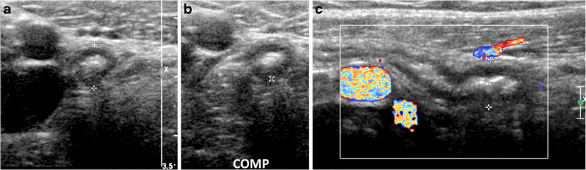 Ultrasound of the pediatric appendix | SpringerLink