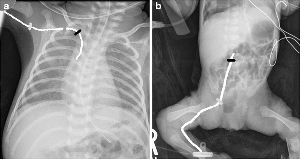 Non-central peripherally inserted central catheters in neonatal ...