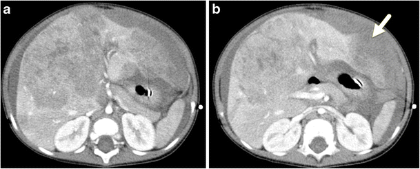 2017 PRETEXT: radiologic staging system for primary hepatic ...