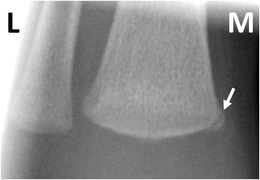 The distal tibial classic metaphyseal lesion: medial versus lateral ...