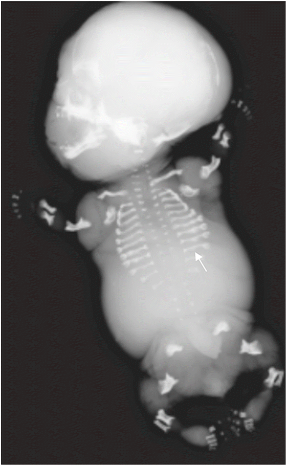 Differential diagnosis of perinatal hypophosphatasia: radiologic ...