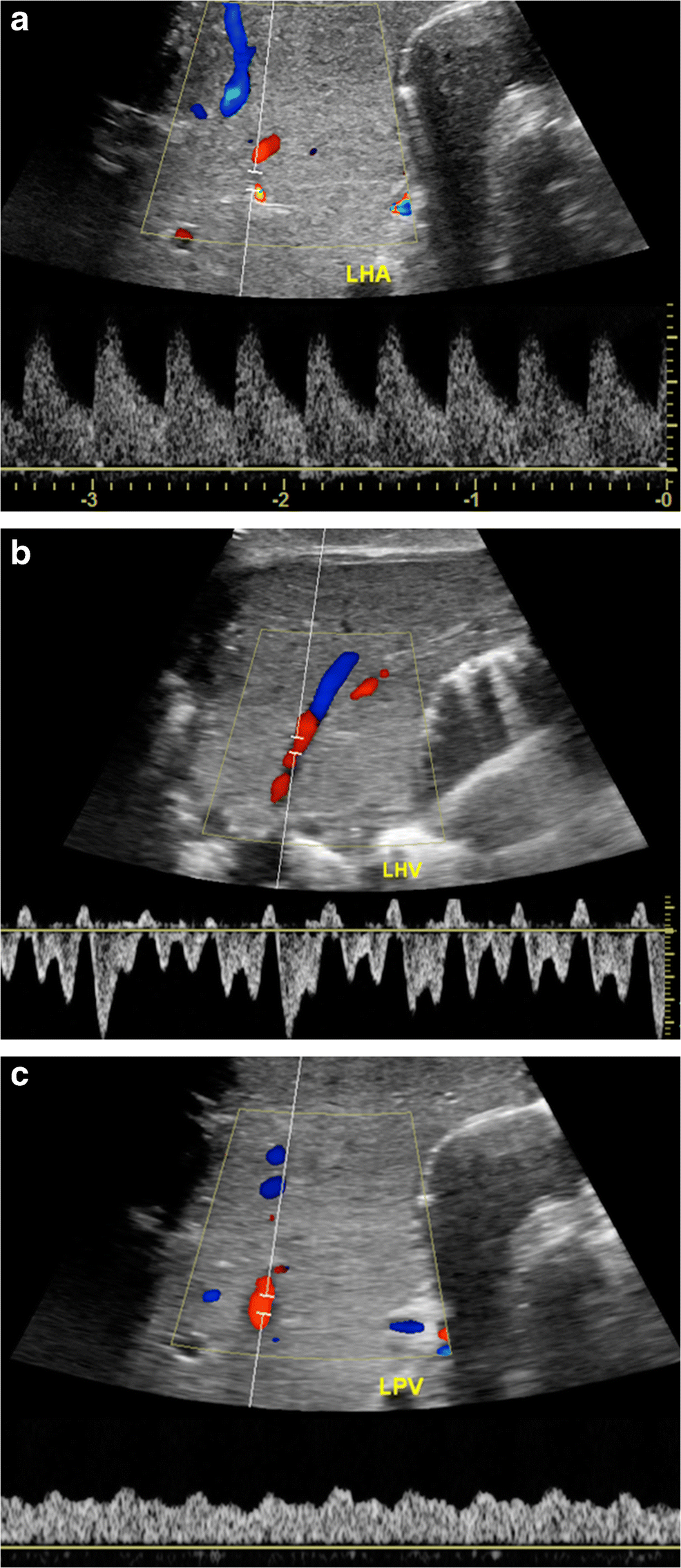 Ultrasound with Doppler evaluation of congenital hepatic vascular ...