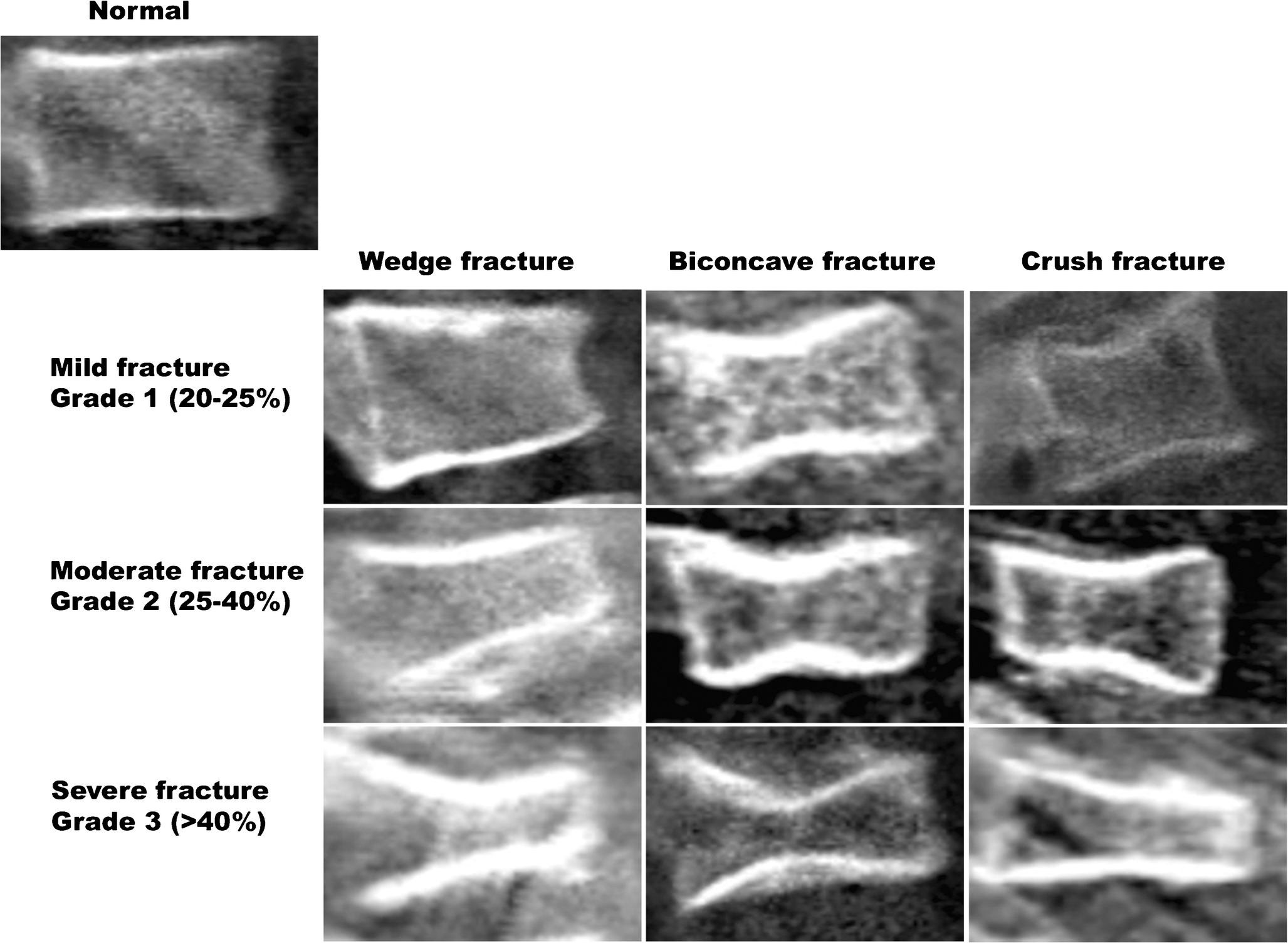 Diagnosis of osteoporotic vertebral fractures in children | SpringerLink