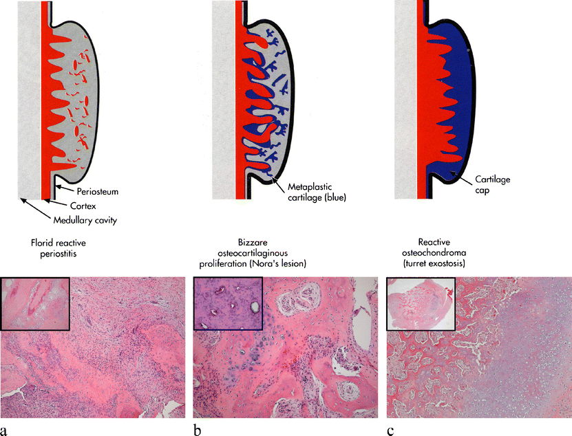 Nora’s lesion, a distinct radiological entity? | SpringerLink