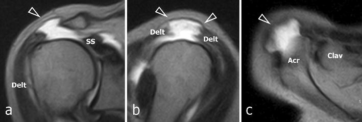 Imaging findings of spontaneous detachment of the deltoid muscle as a ...