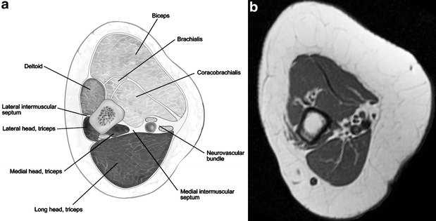 Upper extremity compartmental anatomy: clinical relevance to ...