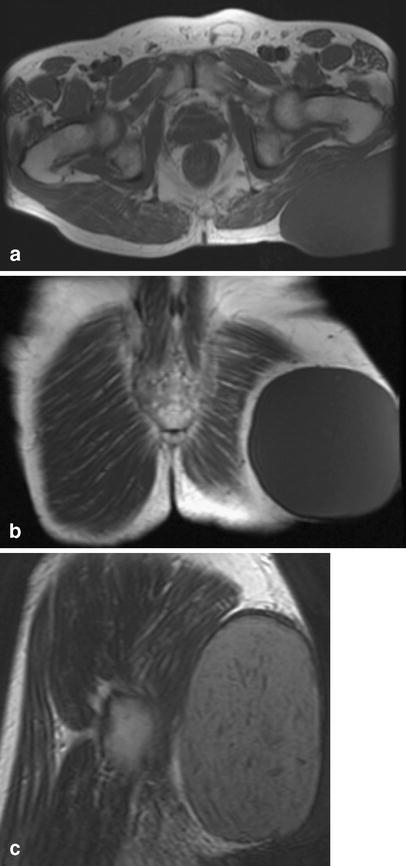 Giant epidermal inclusion cyst of buttock | SpringerLink