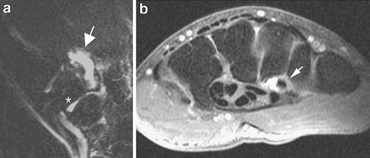 Flexor carpi radialis tendinopathy: spectrum of imaging findings and ...