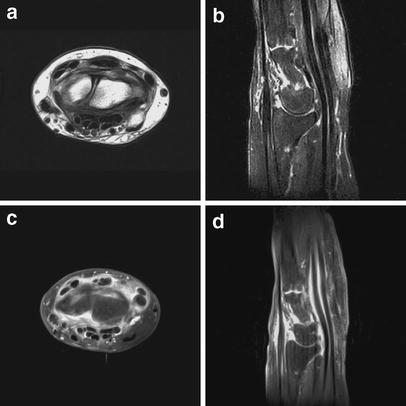 Enhanced MR imaging of tenosynovitis of hand and wrist in inflammatory ...