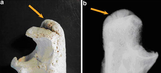 Pattern of osteophytes and enthesophytes in the proximal ulna: an ...
