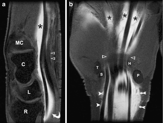 Radial and ulnar bursae of the wrist: cadaveric investigation of ...