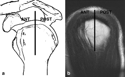 Humeral head cysts and rotator cuff tears: an MR arthrographic study ...