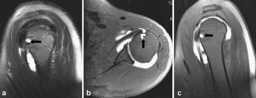 Humeral head cysts and rotator cuff tears: an MR arthrographic study ...