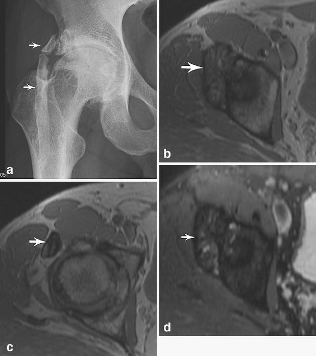 MR imaging of rectus femoris origin injuries | SpringerLink