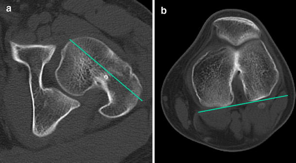 Rotational profile of the lower extremity in achondroplasia: computed ...