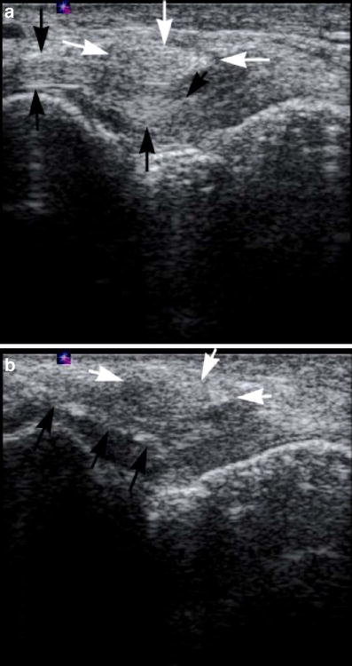 Sonography of the superomedial part of the spring ligament complex of ...