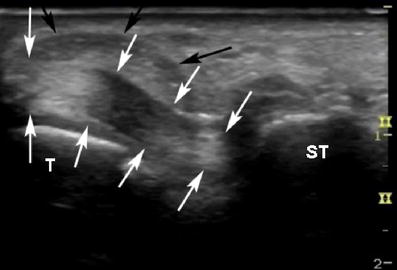 Sonography of the superomedial part of the spring ligament complex of ...