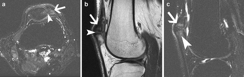 MRI findings in bipartite patella | SpringerLink