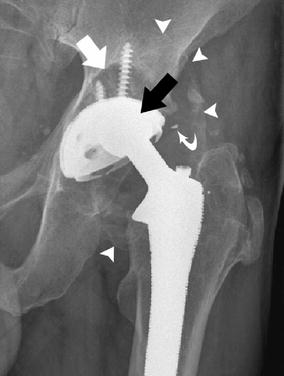 The imaging appearances of metallosis | SpringerLink