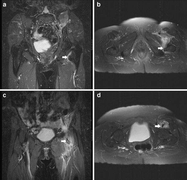 Iliopsoas injury: an MRI study of patterns and prevalence correlated ...
