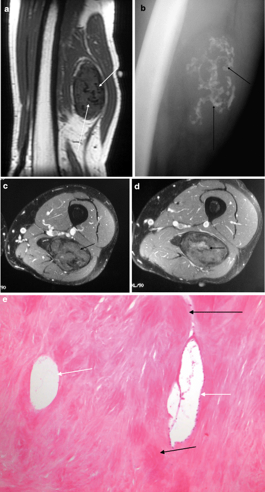 Angioleiomyoma: magnetic resonance imaging features in ten cases ...
