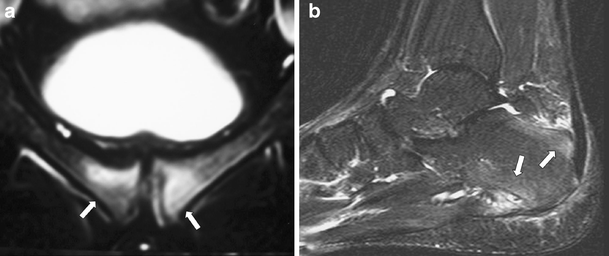 Bone marrow edema syndrome | SpringerLink