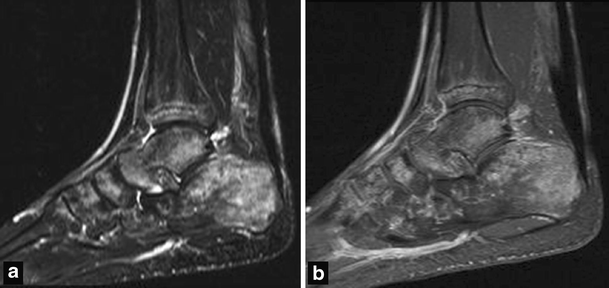 Bone marrow edema syndrome | SpringerLink
