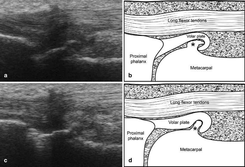 Ultrasound findings of the locked metacarpophalangeal joint | SpringerLink