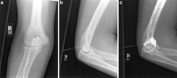 The posterior transtriceps approach for elbow arthrography: a forgotten ...