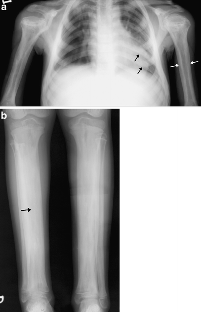 Camurati–Engelmann disease: imaging, clinical features and differential ...