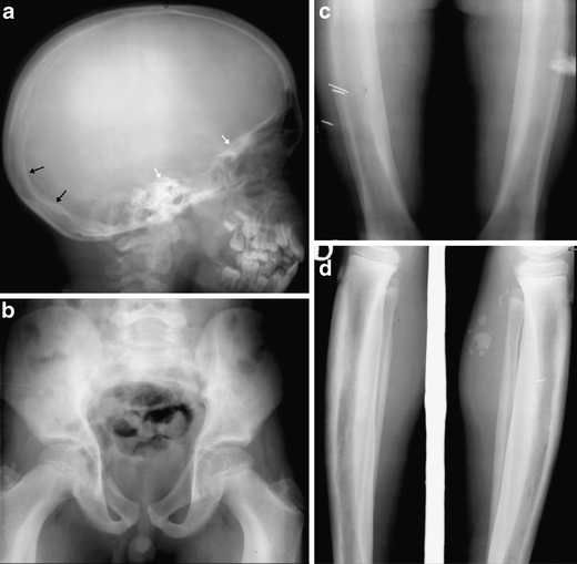 Camurati–Engelmann disease: imaging, clinical features and differential ...