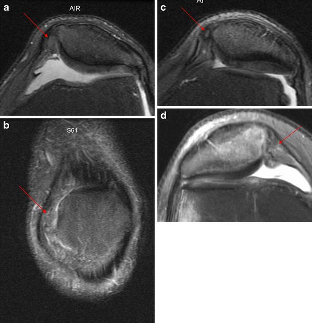 Medial patellar ossification after patellar instability: a radiographic ...