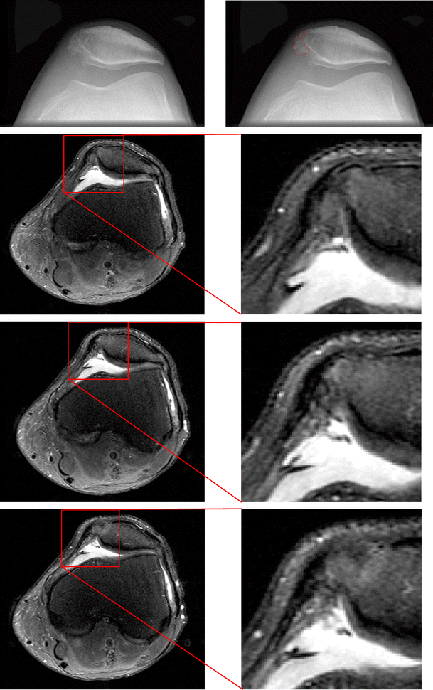 Medial patellar ossification after patellar instability: a radiographic ...