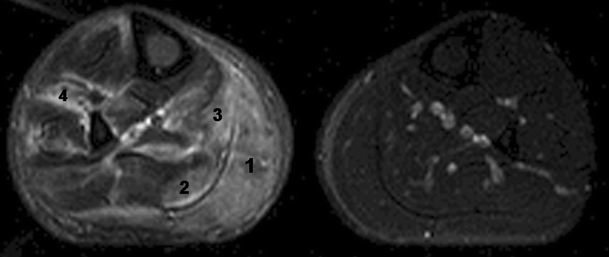 MR imaging findings of focal myositis: a pseudotumour that may mimic ...
