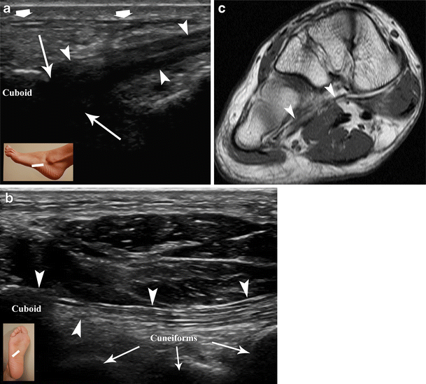 Musculoskeletal sonography of the normal foot | SpringerLink