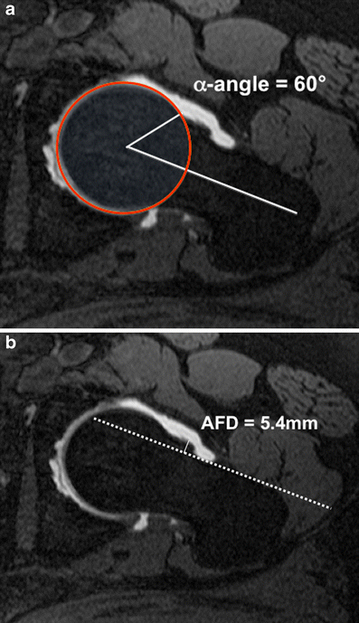 Cam-type femoral-acetabular impingement: is the alpha angle the best MR ...
