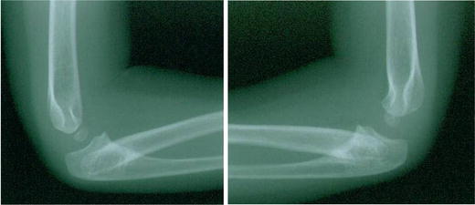 The developmental spectrum of proximal radioulnar synostosis | SpringerLink