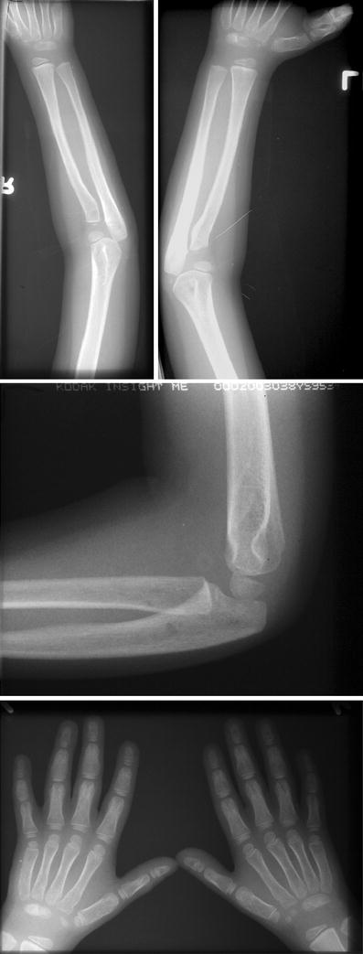 The developmental spectrum of proximal radioulnar synostosis | SpringerLink