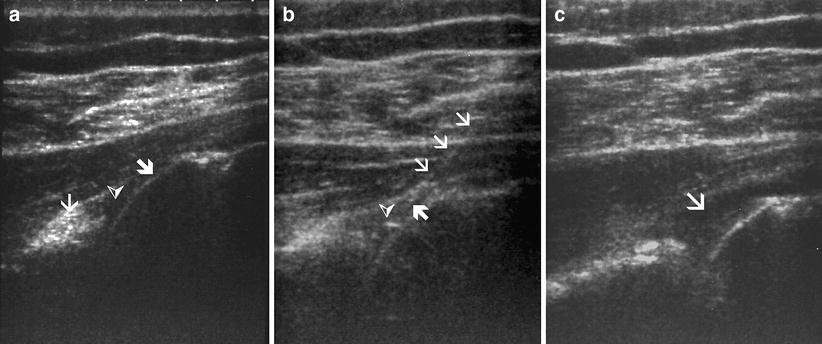 Efficacy of ultrasonography-guided shoulder MR arthrography using a ...