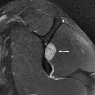 Soft tissue mass at the infrascapular fossa | SpringerLink