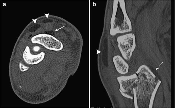 Floating fat in the wrist joint and in the tendon sheaths | SpringerLink