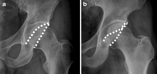 Herniation pits in the femoral neck: a radiographic indicator of ...
