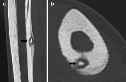 Bony sequestrum: a radiologic review | SpringerLink