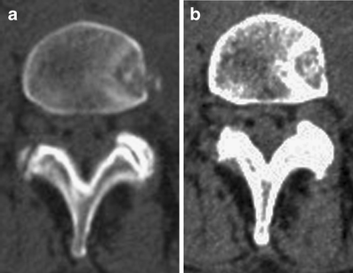 Bony sequestrum: a radiologic review | SpringerLink