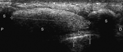 Ultrasound features of tophi in chronic tophaceous gout | SpringerLink