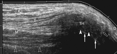 Ultrasound features of tophi in chronic tophaceous gout | SpringerLink