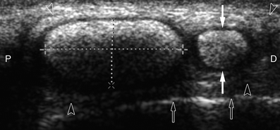 Ultrasound features of tophi in chronic tophaceous gout | SpringerLink