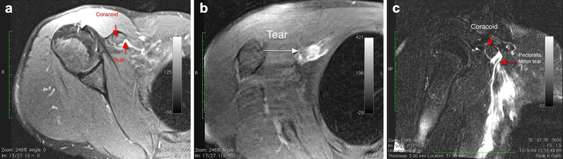 Isolated pectoralis minor tendon tear in a professional ice hockey ...
