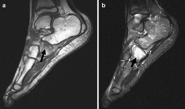Review of common and unusual causes of lateral ankle pain | SpringerLink